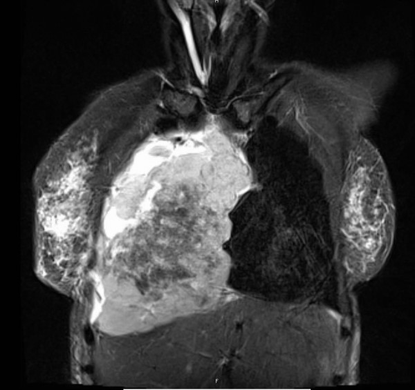 Mediastinum Cyst - Thoracic Surgery - Lung Cancer Surgery - VATS